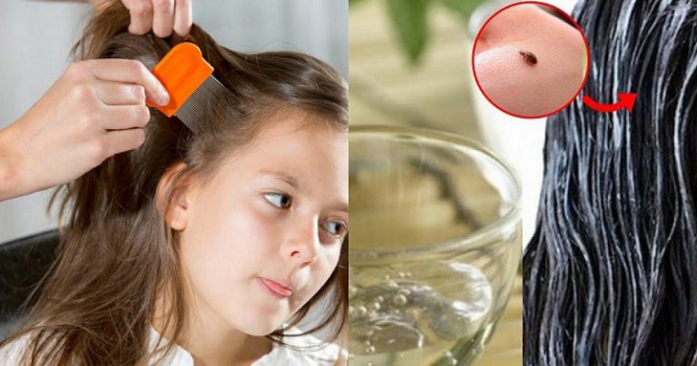 TOP 5 cách trị chấy tại nhà an toàn và hiệu quả cao bạn nên áp dụng